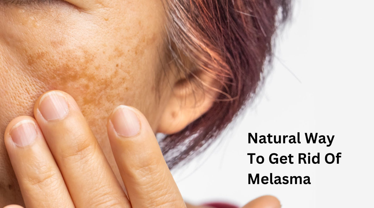 Natural Way To Get Rid Of Melasma – HERBCIENCE